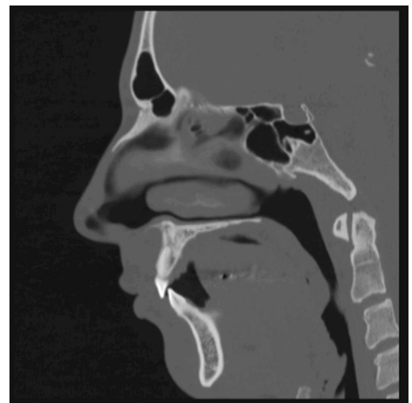 Sagittal ct scan of face of basketball player with facial