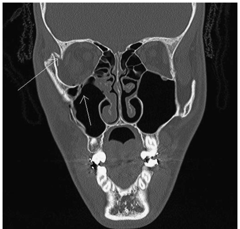 Le fort | fracture of the maxilla after patient struck by a