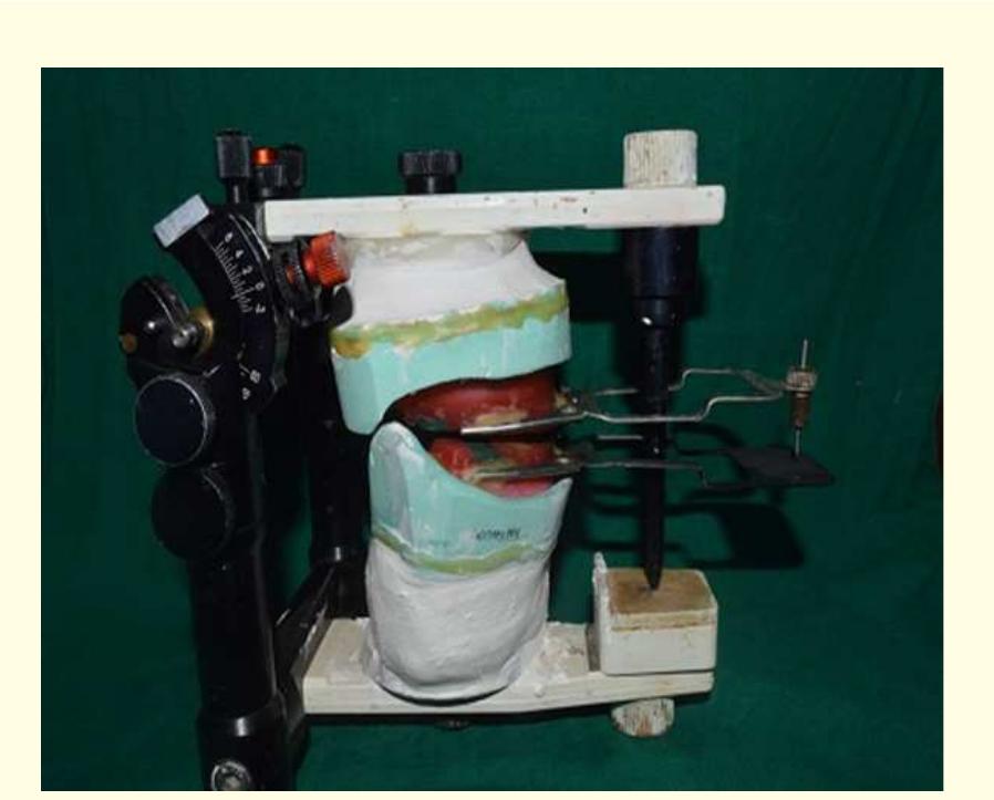 (PDF) An Understanding of Gothic Arch Tracing- A Clinical and Academic ...