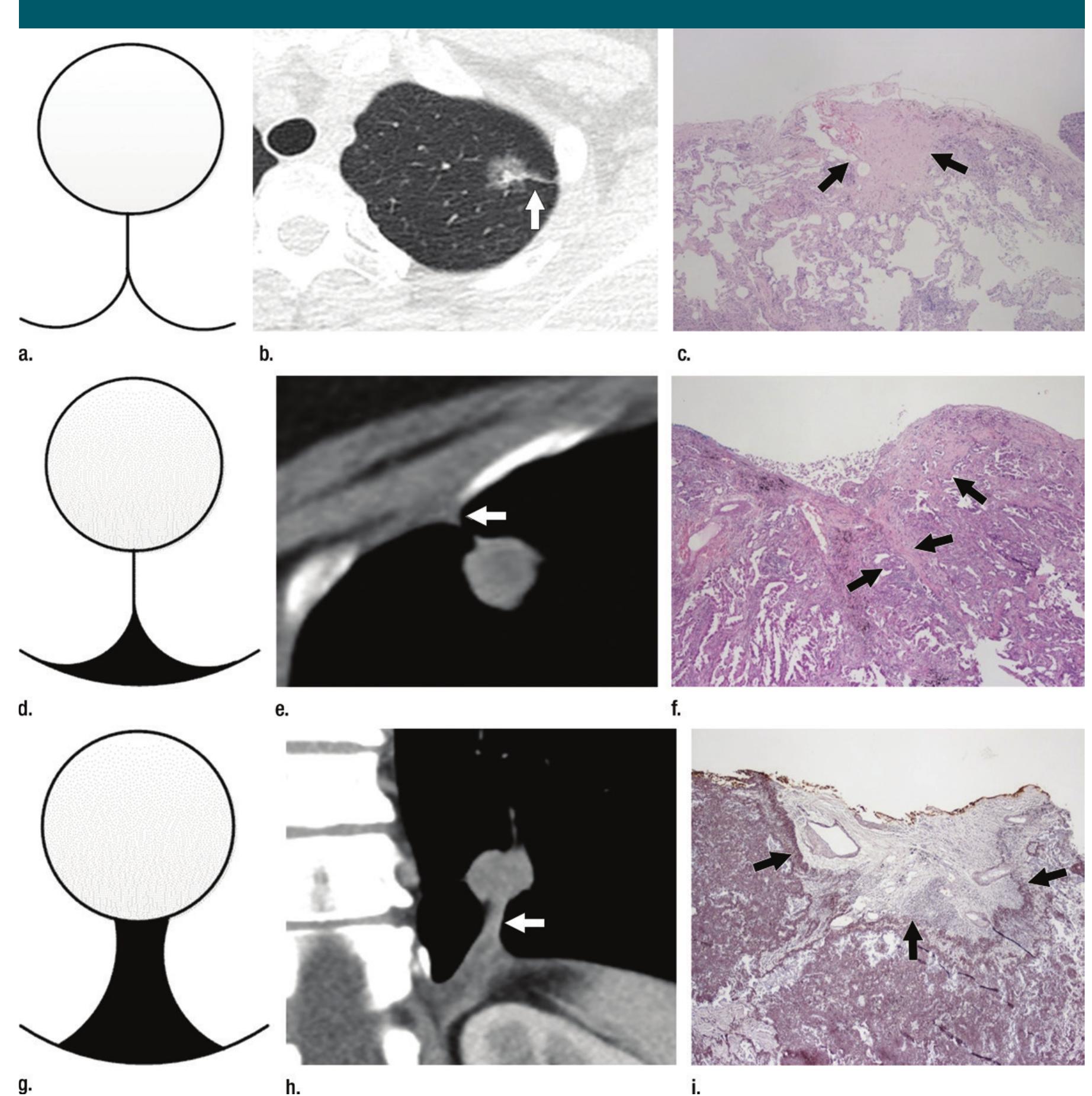Types of pleural tags represented by pictograms and ct