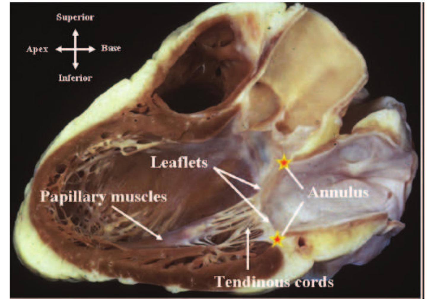 Figure 8 - from Mitral valve posterior leaflet morphology