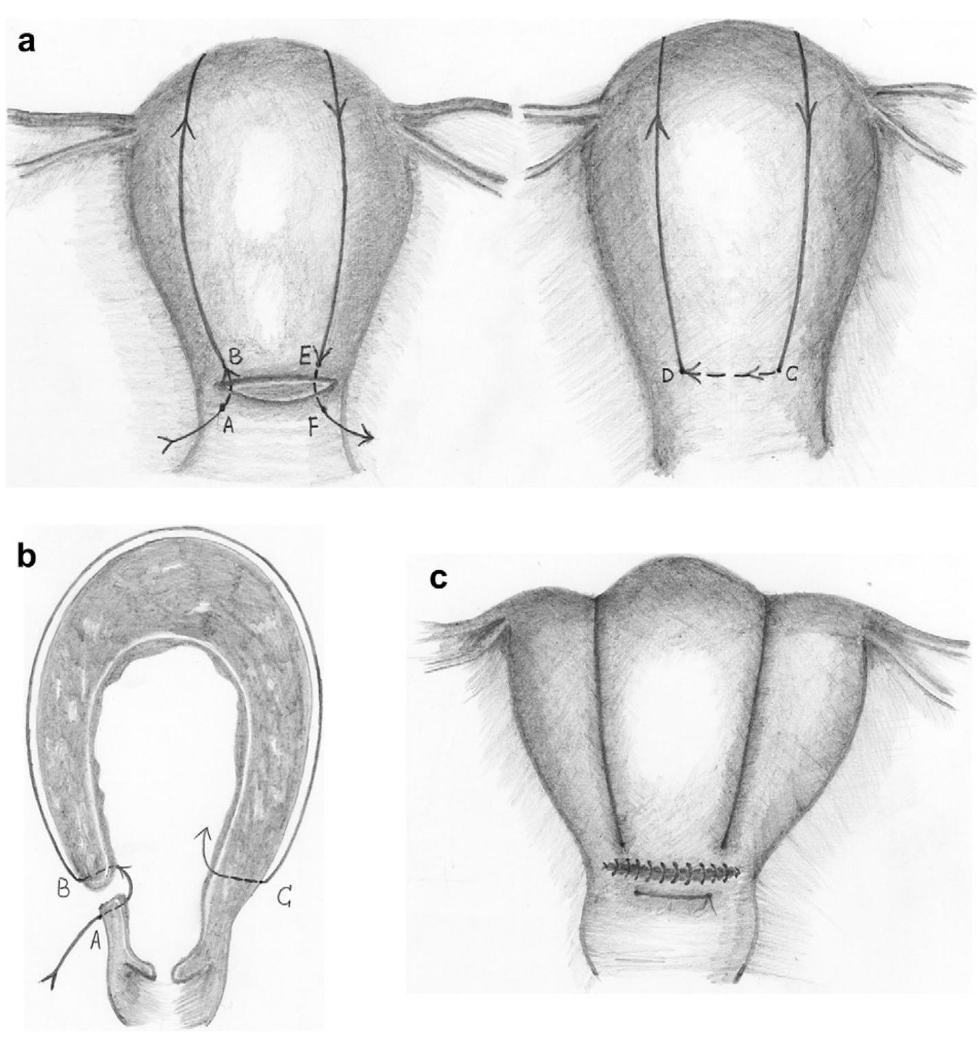 B-lynch suture: (a) anterior and posterior views; (b)