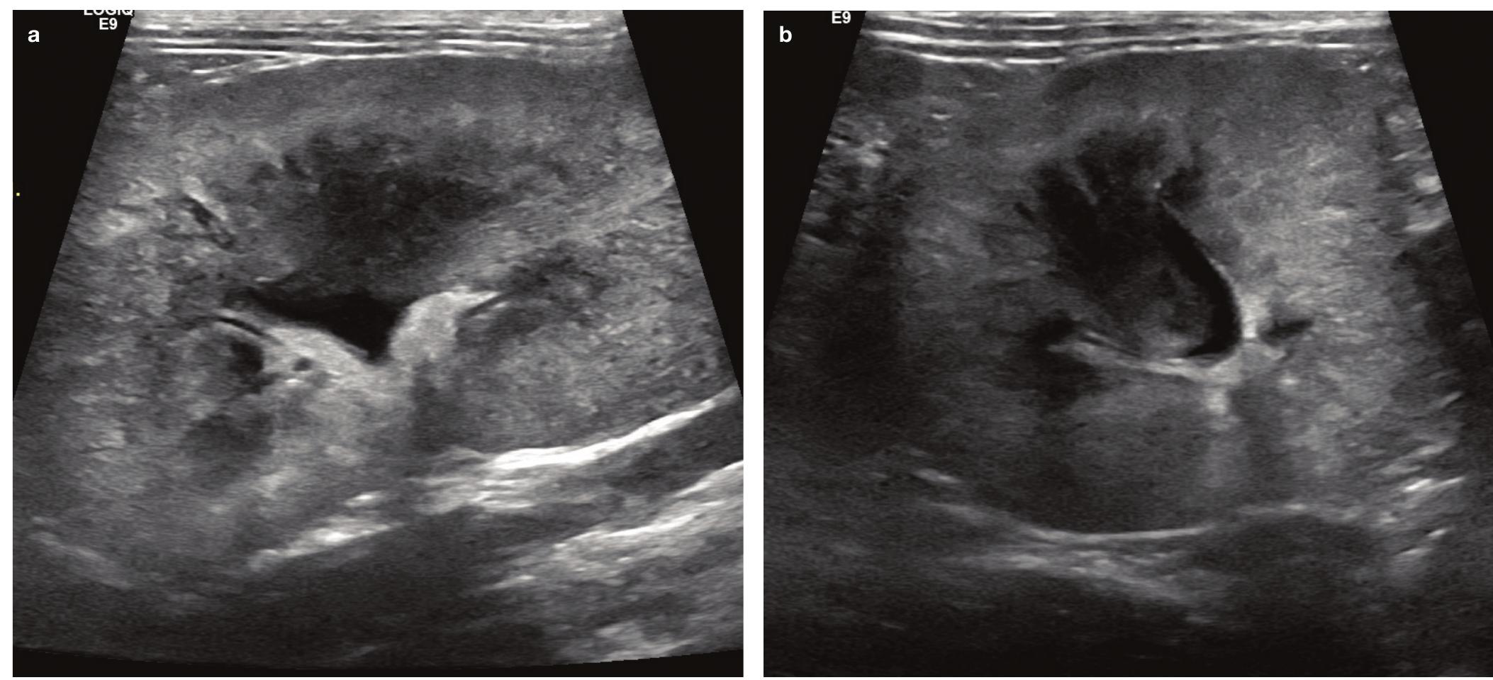 Longitudinal (a) and transverse (b) ultrasound images of the
