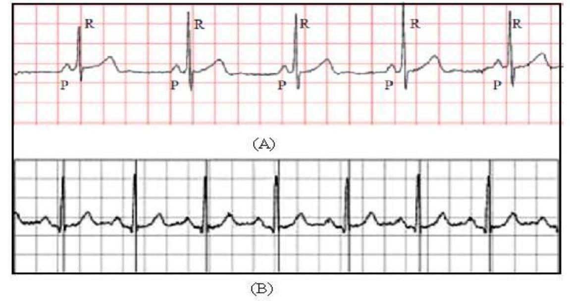 8 (a) normal sinus rhythm, (b) sinus tachycardia when the