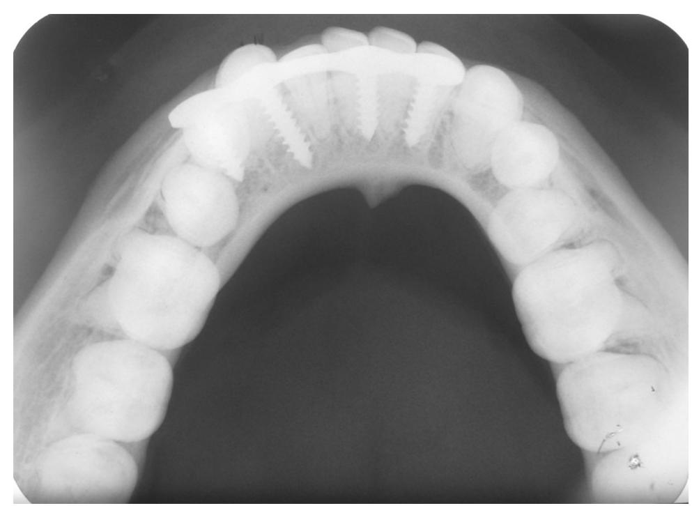 Group a post-op occlusal view fig. 5 group a post-op opg