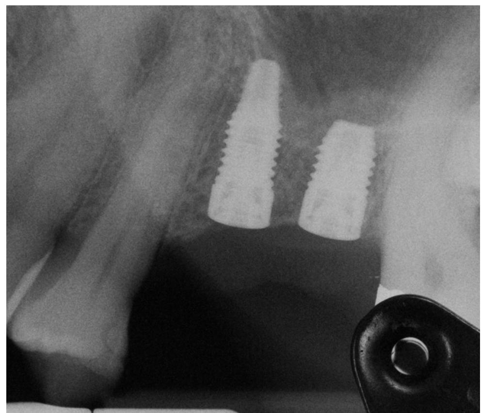 Postoperative periapical radiograph showing sinus floor