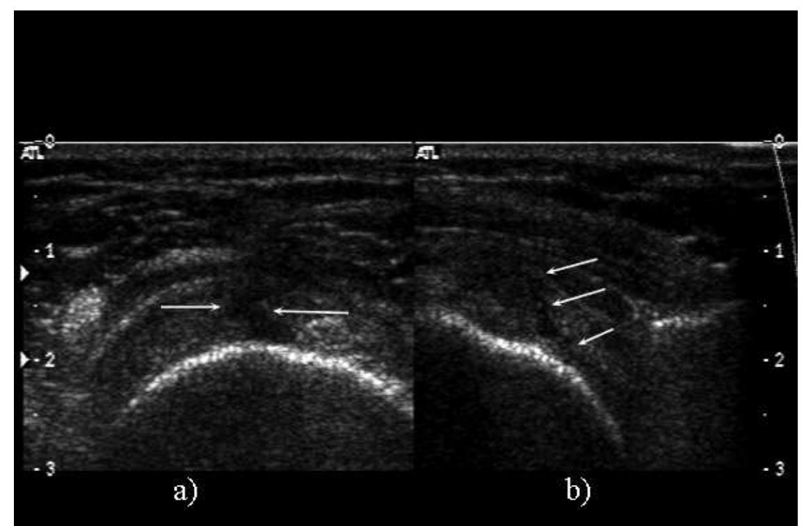 Total tear of the supraspinatus tendon (arrows), a)