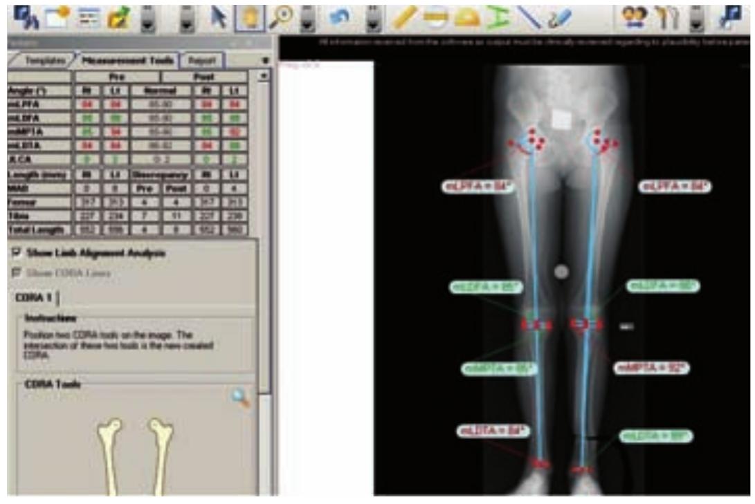 A simulated osteotomy of the distal tibia is shown in the