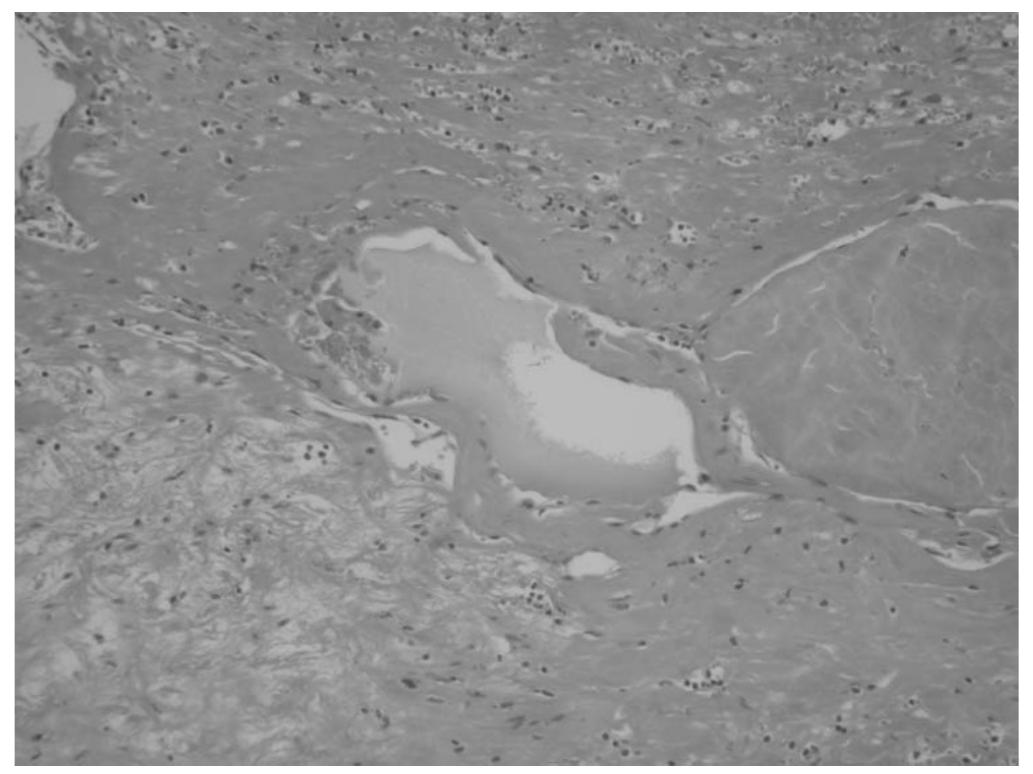 Hemangiomas are often asymptomatic and undergo enlargement