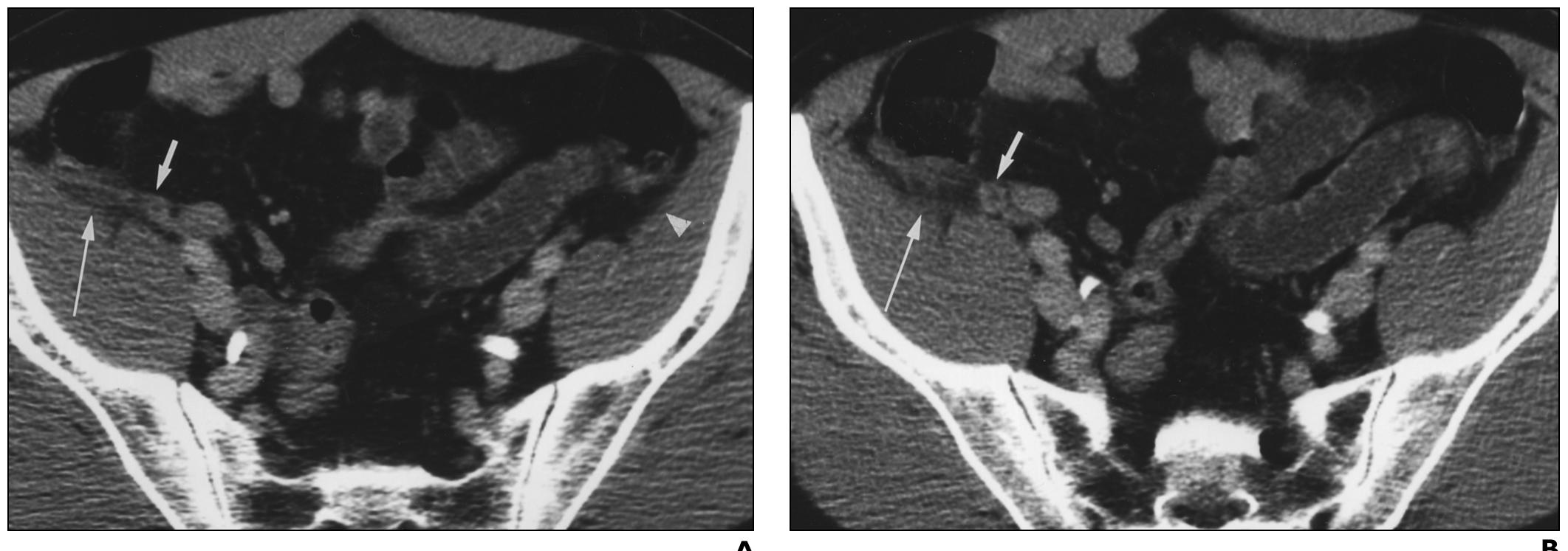 Note.—abs. = abscess, aaa = abdominal aortic aneurysm, app.