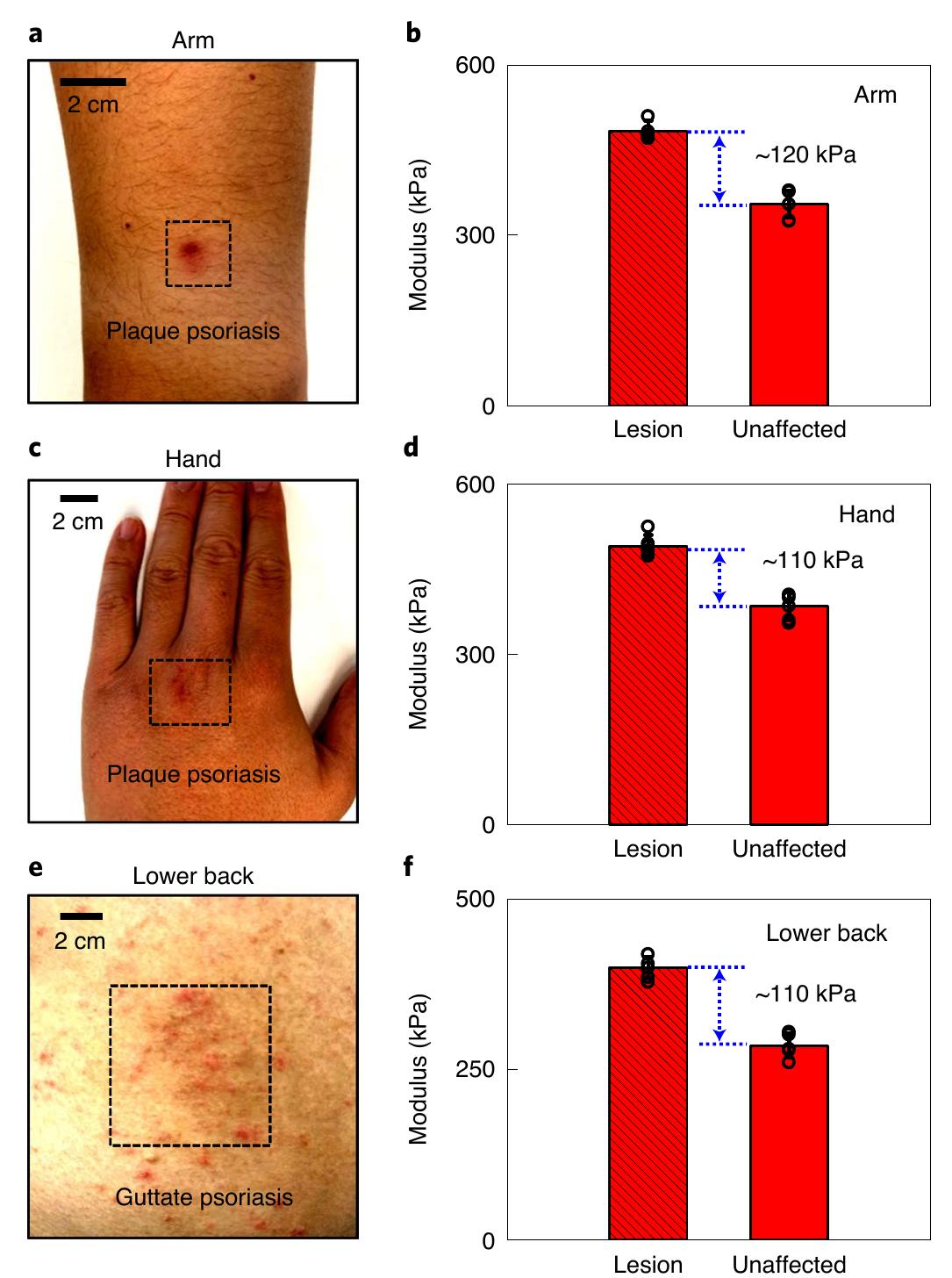 | measurements of skin lesions via miniaturized designs of