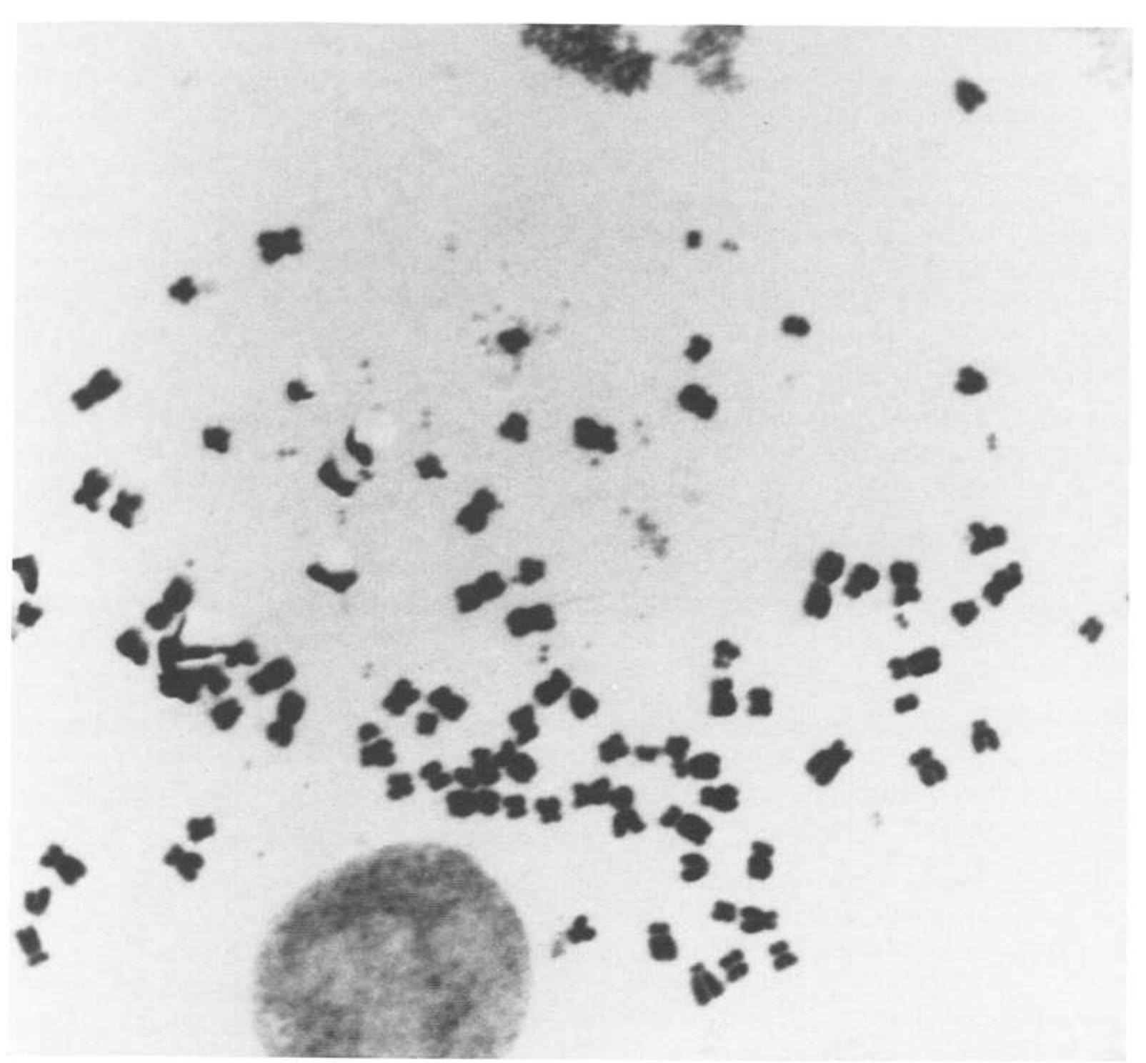 , 12, dlkp-a abnormal metaphase, showing numerous dms,