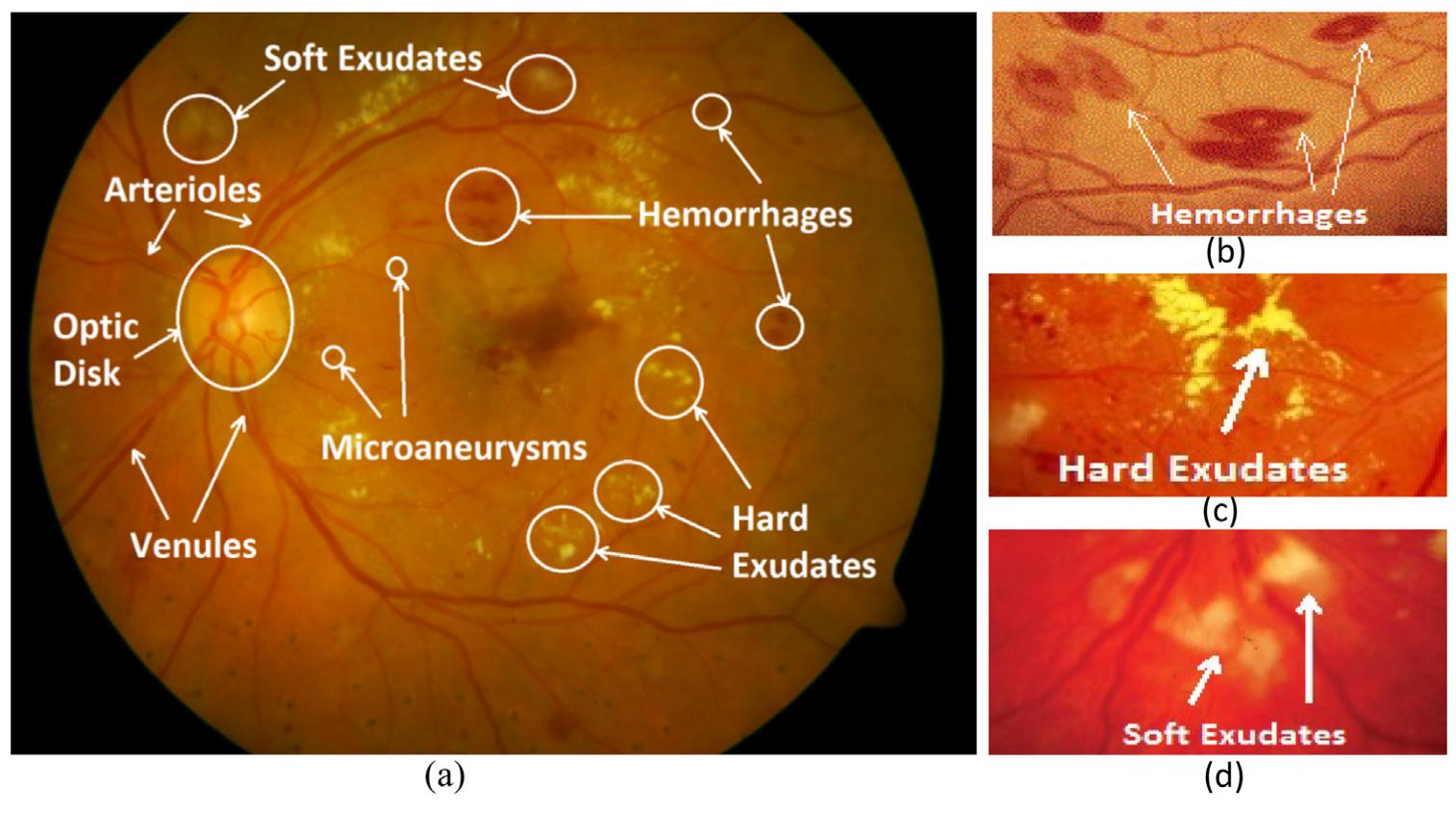 (a) retinal image with pathologies (b) hemorrhages (c) soft
