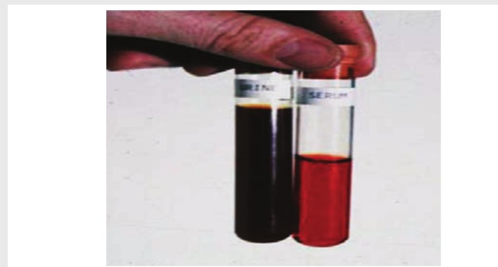 The differentitation of hemoglobinuria from hematuris.