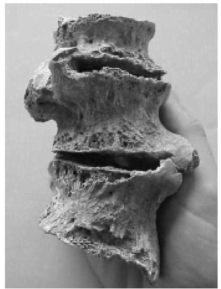 Lumbar vertebrae (l2-l4) (anterior view).