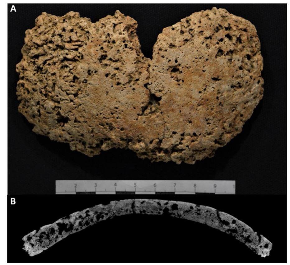 Cranial vault of t. 170: a) right parietal bone, superior