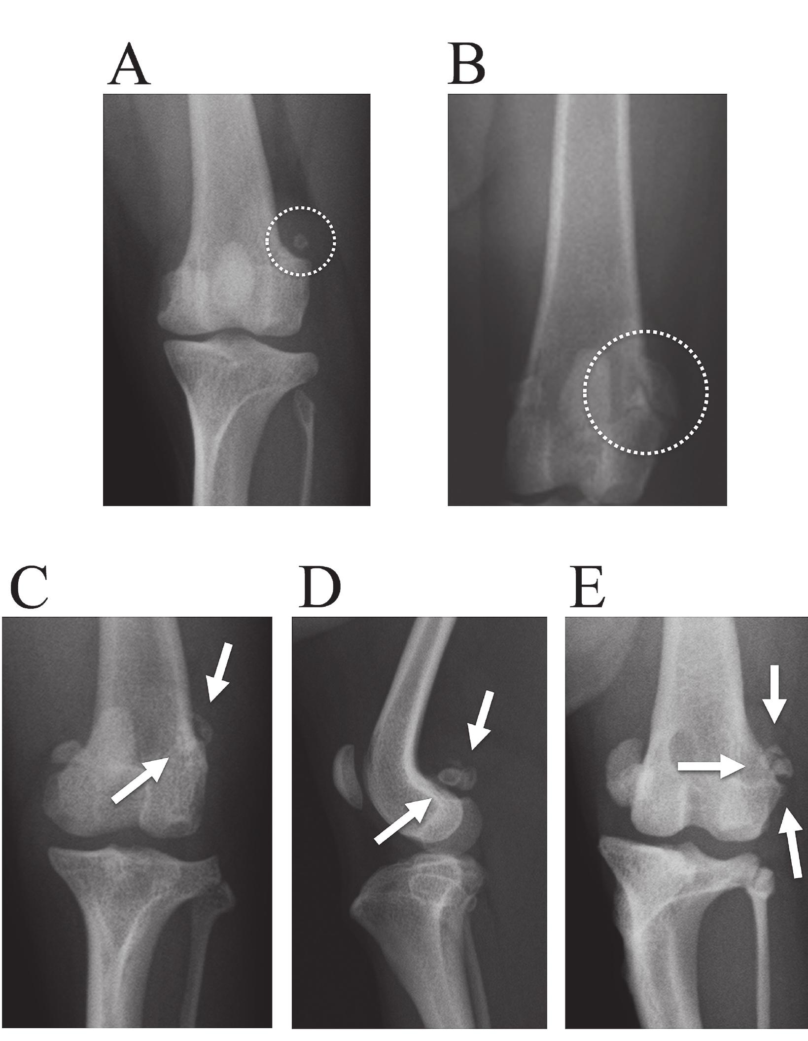 Deformity of the lateral fabella. (a) hypoplasia