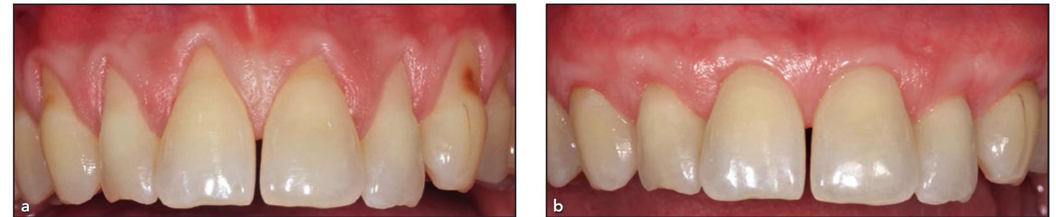 (a) baseline situation showing multiple gingival recession