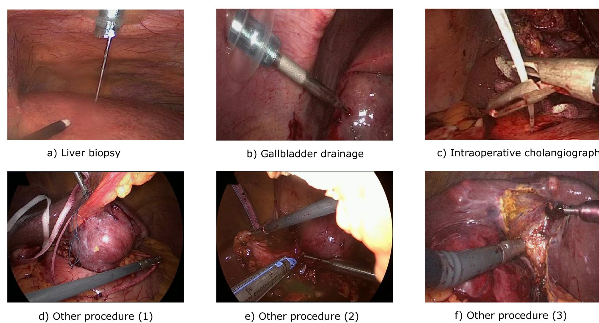 Example of surgical scenes for surgical phases (from our