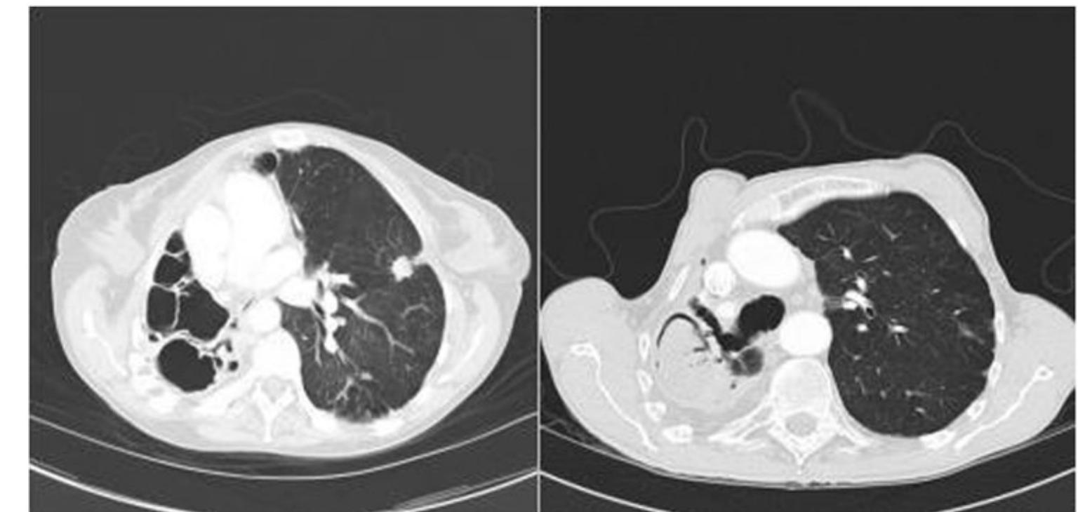 Chest ct scans (a) of patient 3, (b) of patient 4.