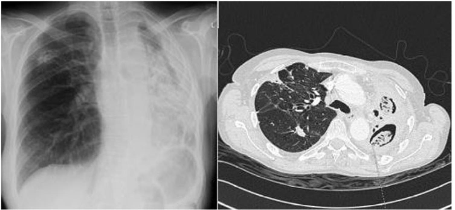 (a) chest x-ray and (b) chest ct scan of patient 8.