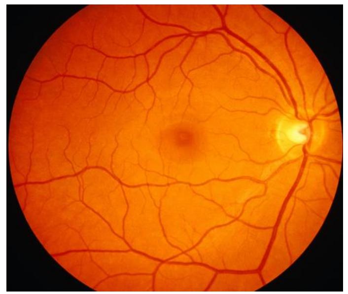Retina image[31] a) dataset - the retinal images used here