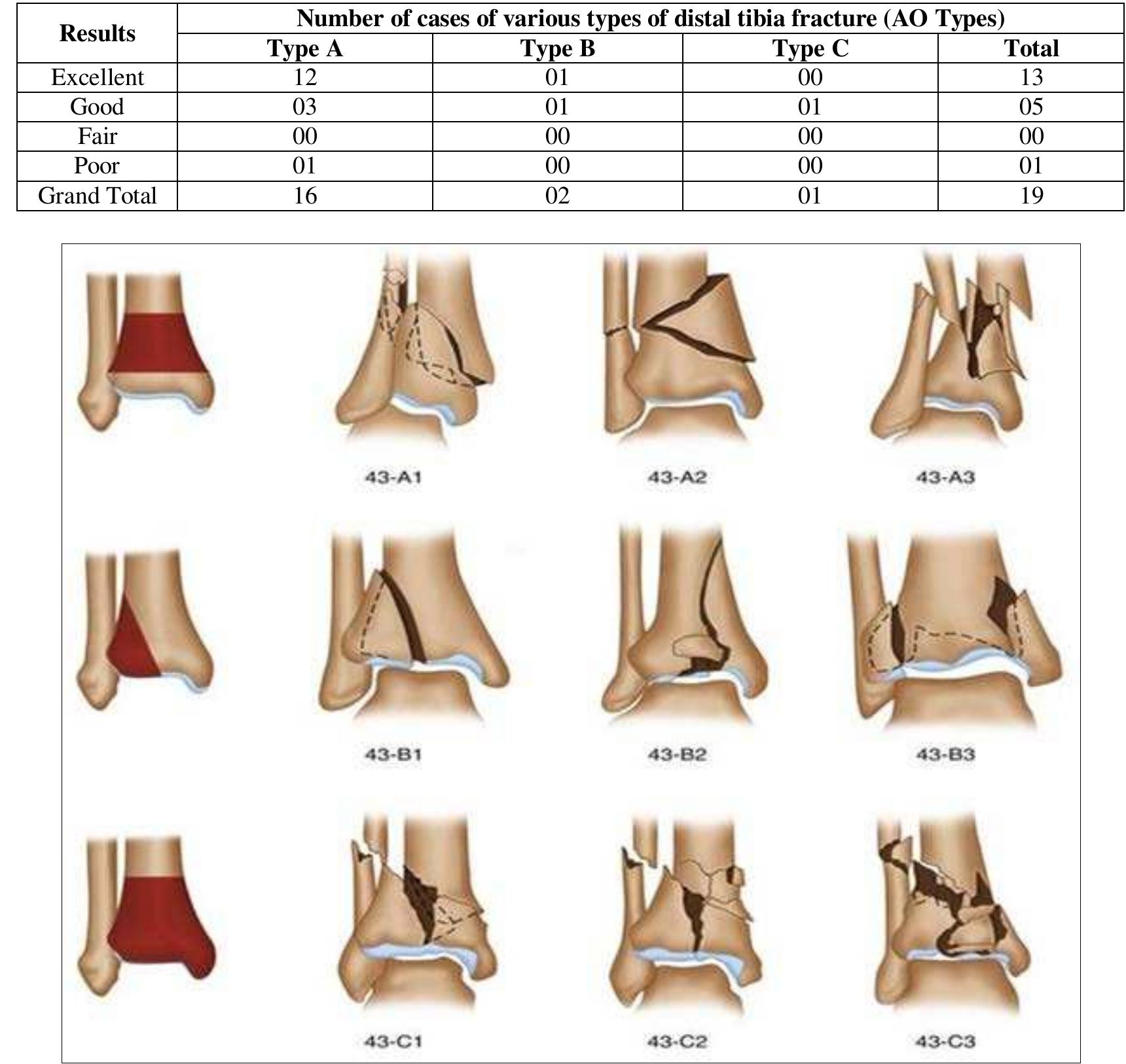 Ao classification of distal tibial fractures table 1: