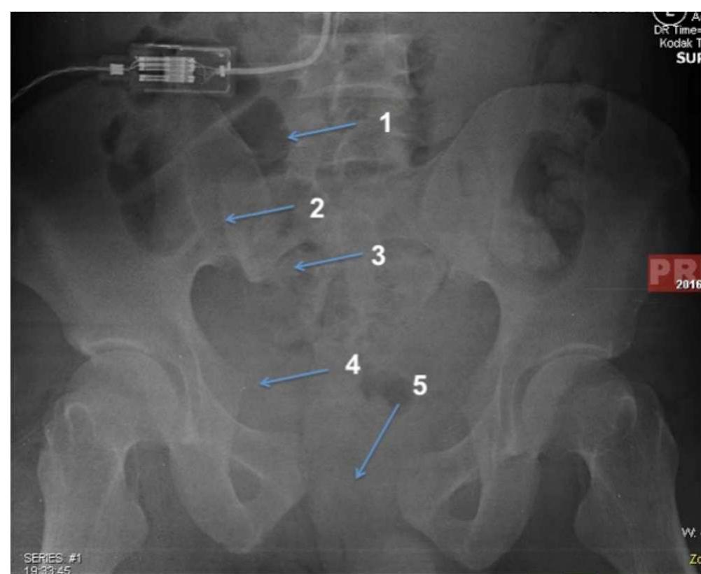 (PDF) Vertical shear pelvic injury: evaluation, management, and ...