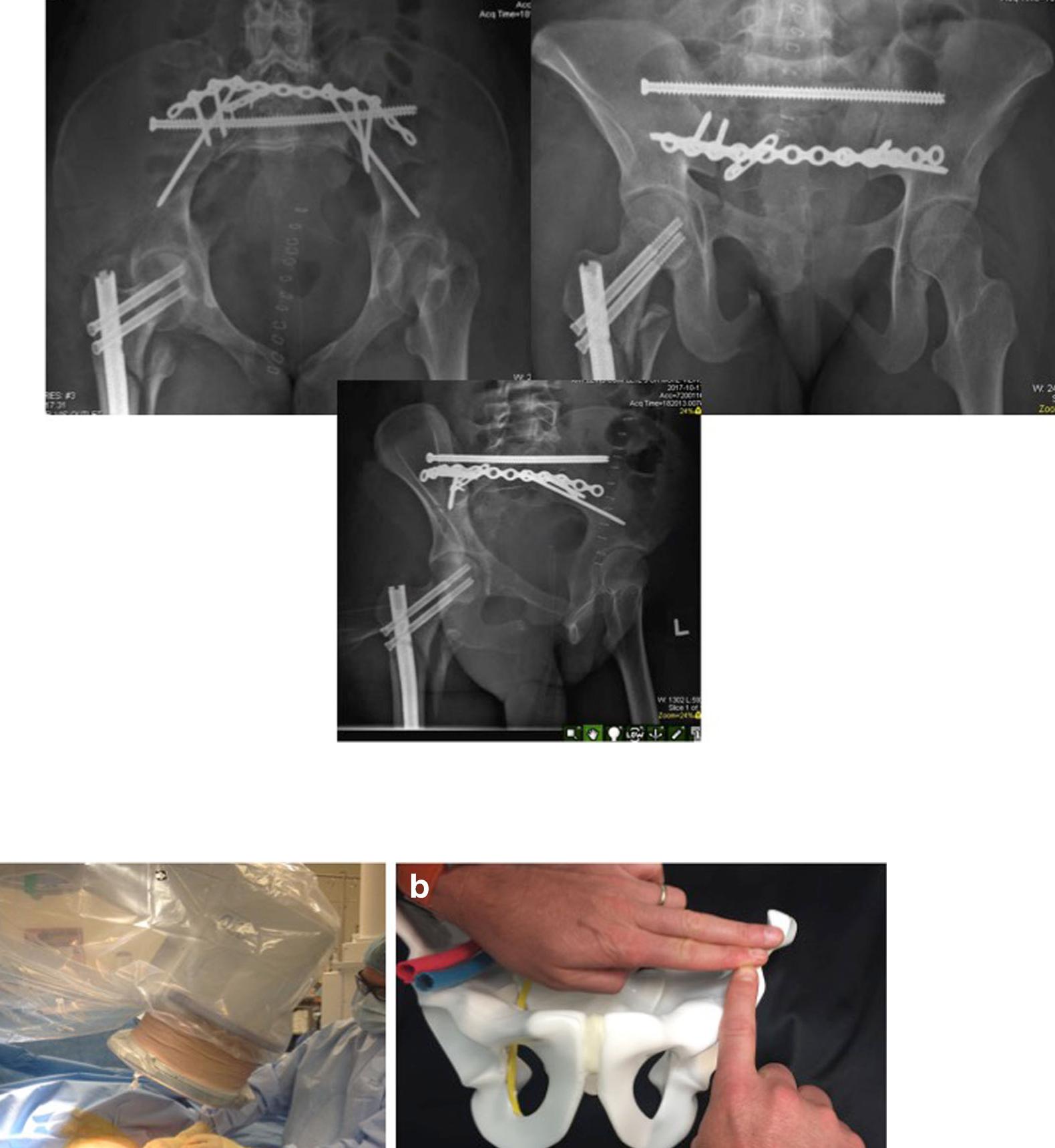 Figure 2 - Vertical shear pelvic injury: evaluation,
