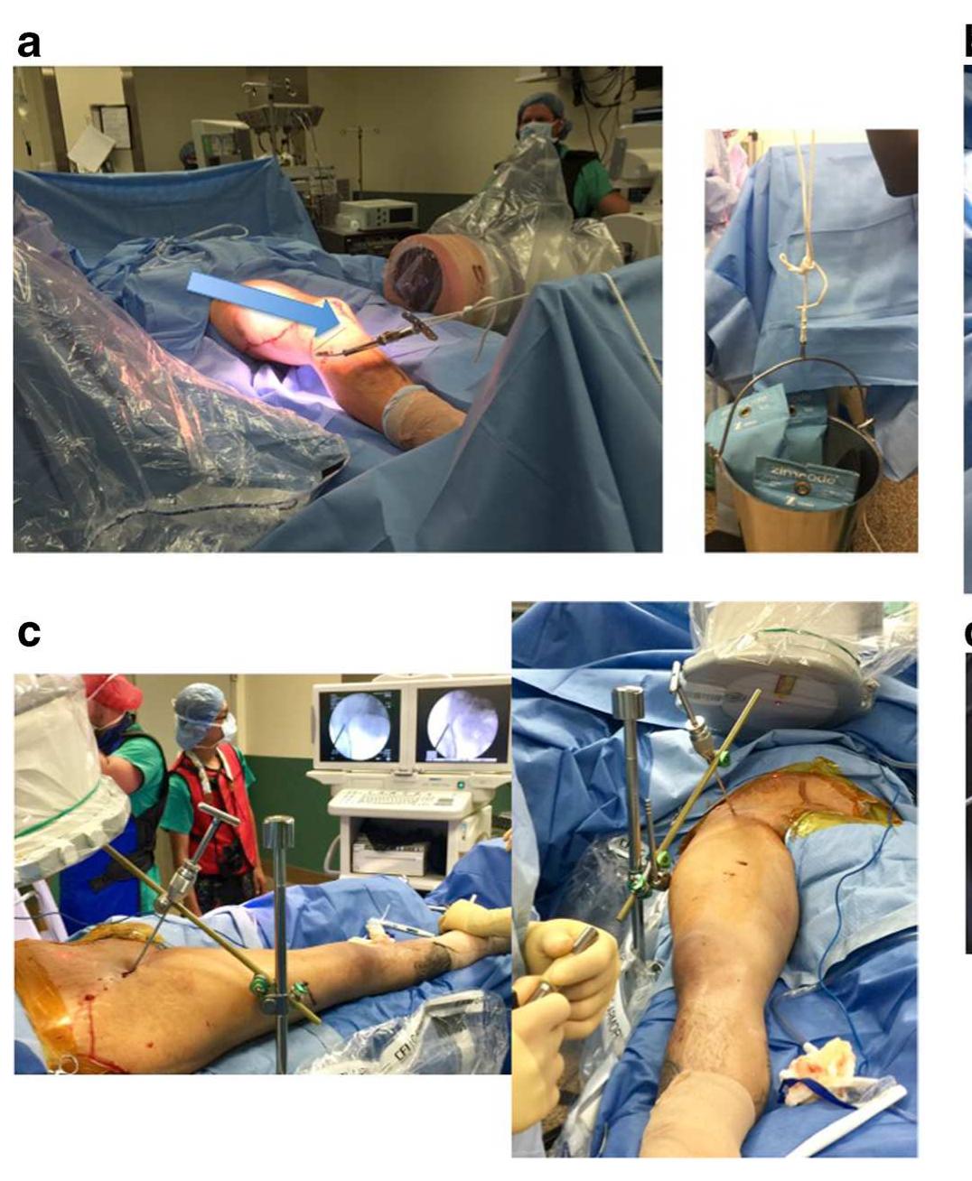 A use of distal femoral or proximal tibia traction with the