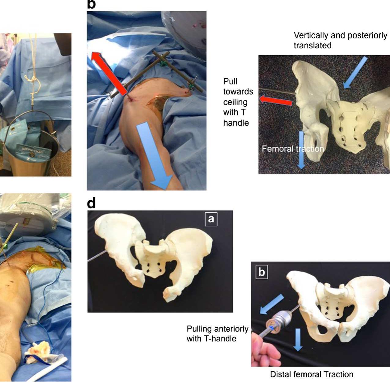 (PDF) Vertical shear pelvic injury: evaluation, management, and ...