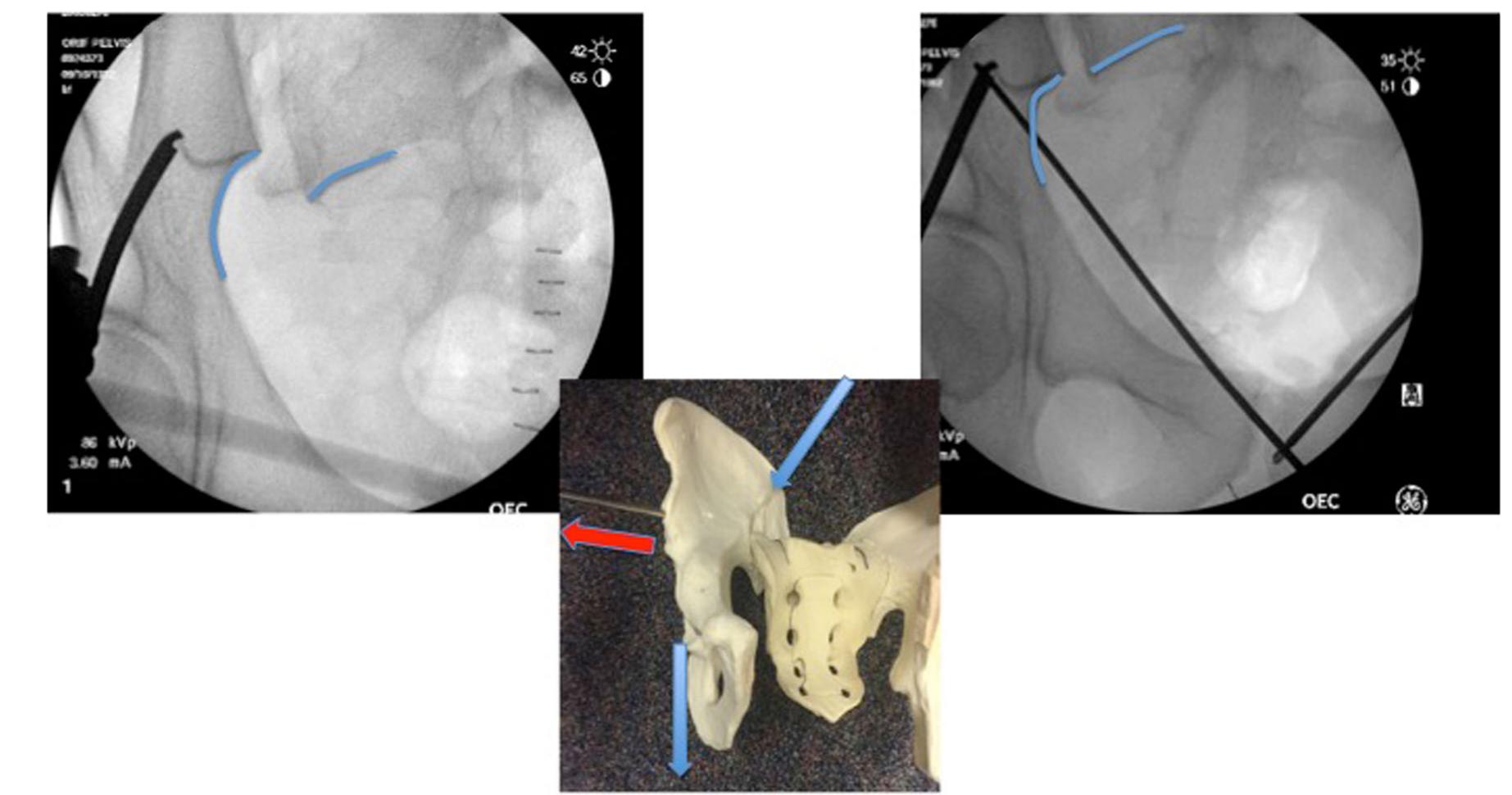 (PDF) Vertical shear pelvic injury: evaluation, management, and ...