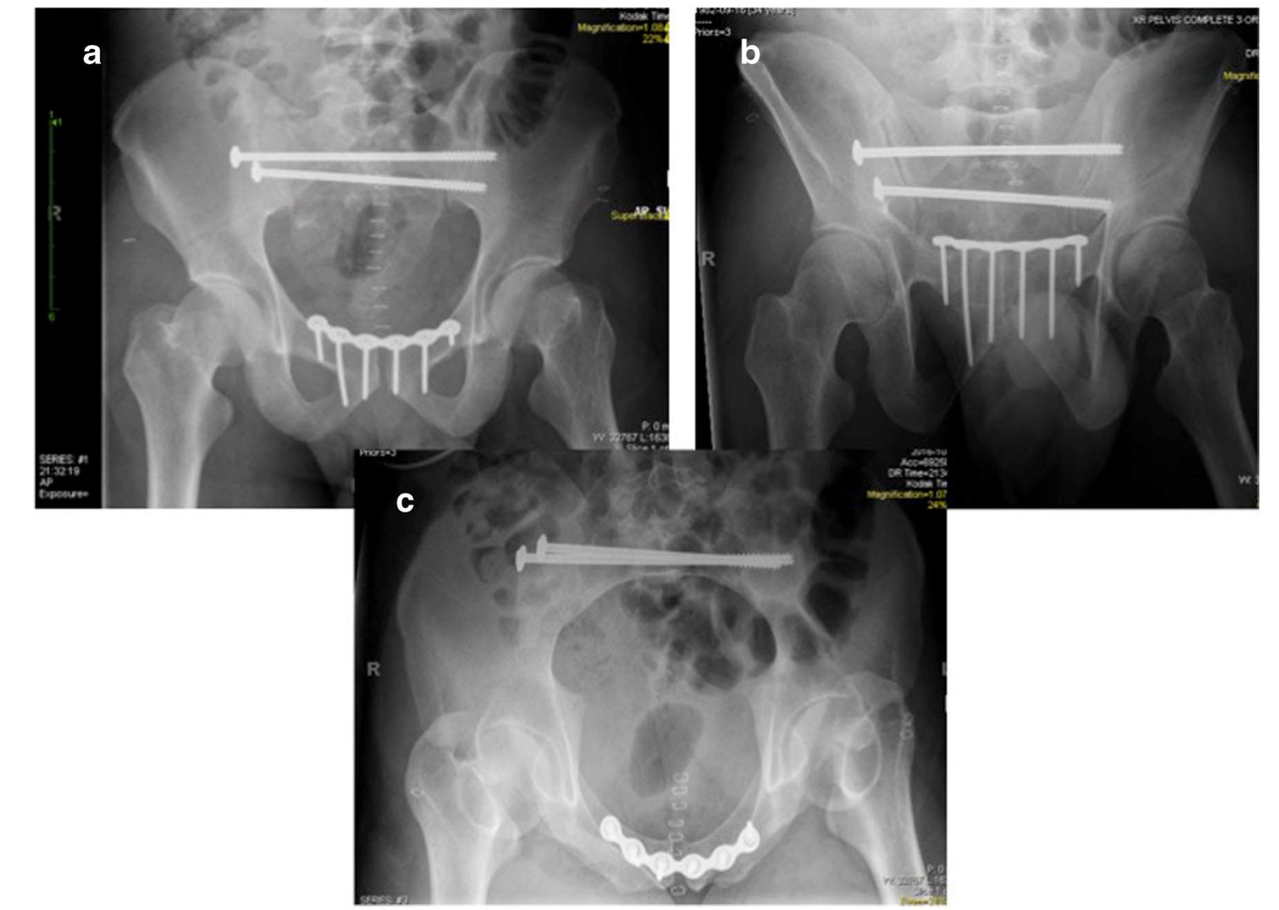 (PDF) Vertical shear pelvic injury: evaluation, management, and ...