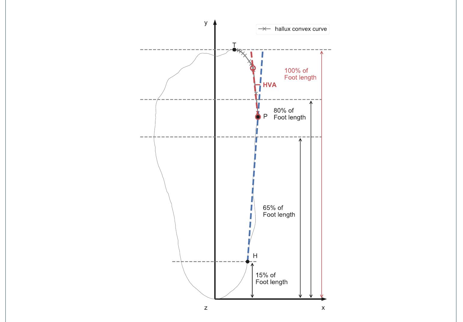 The measurement of hallux valgus angle (hva) from a 3d foot