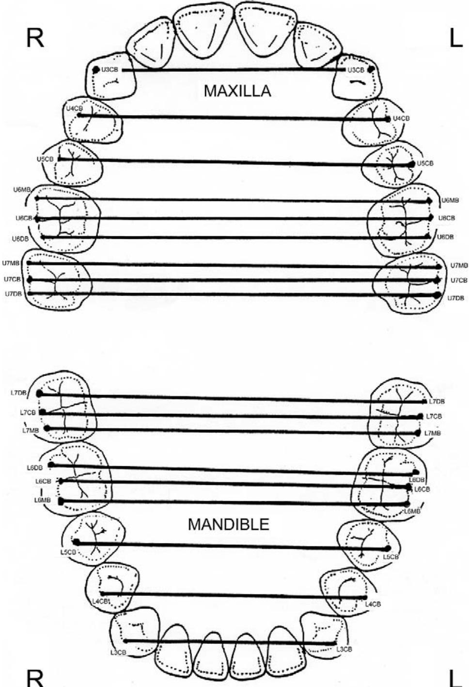 Diagrammatic illustration of dental arch width measure- ment