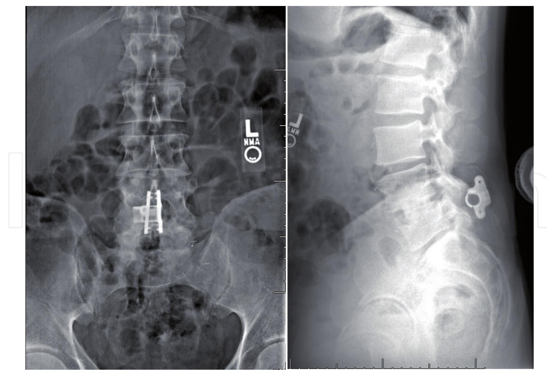 Figure 5 - The Aspen MIS Spinous Process Fusion System