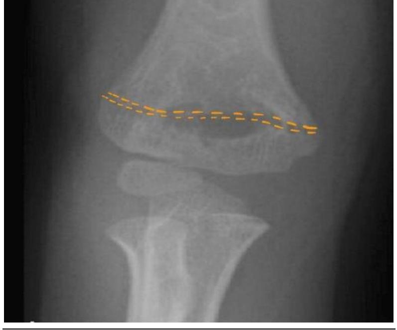 , congruency of fracture line in distal and proximal
