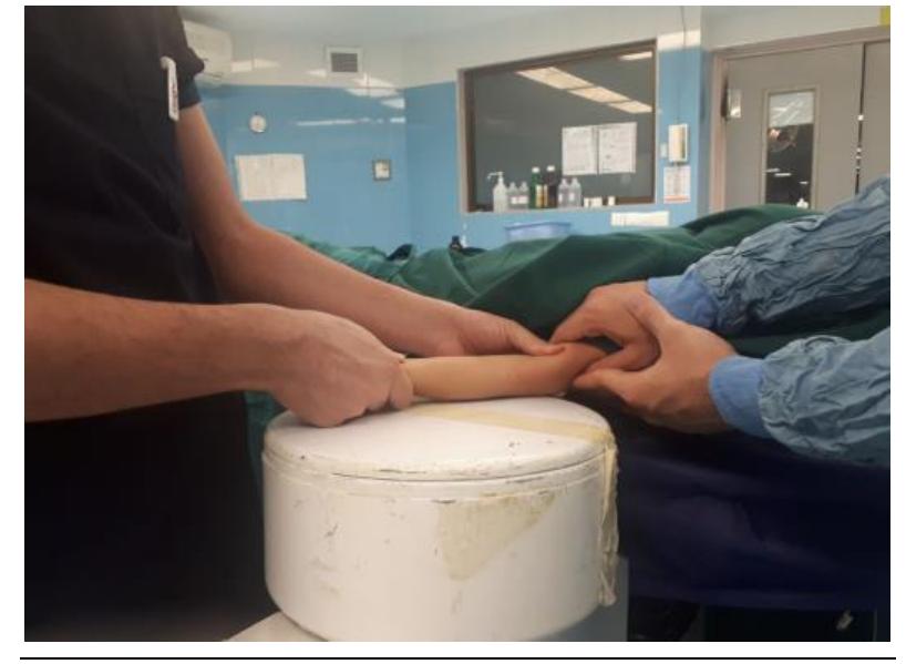 Correction of flexion deformity of distal fragment now, the