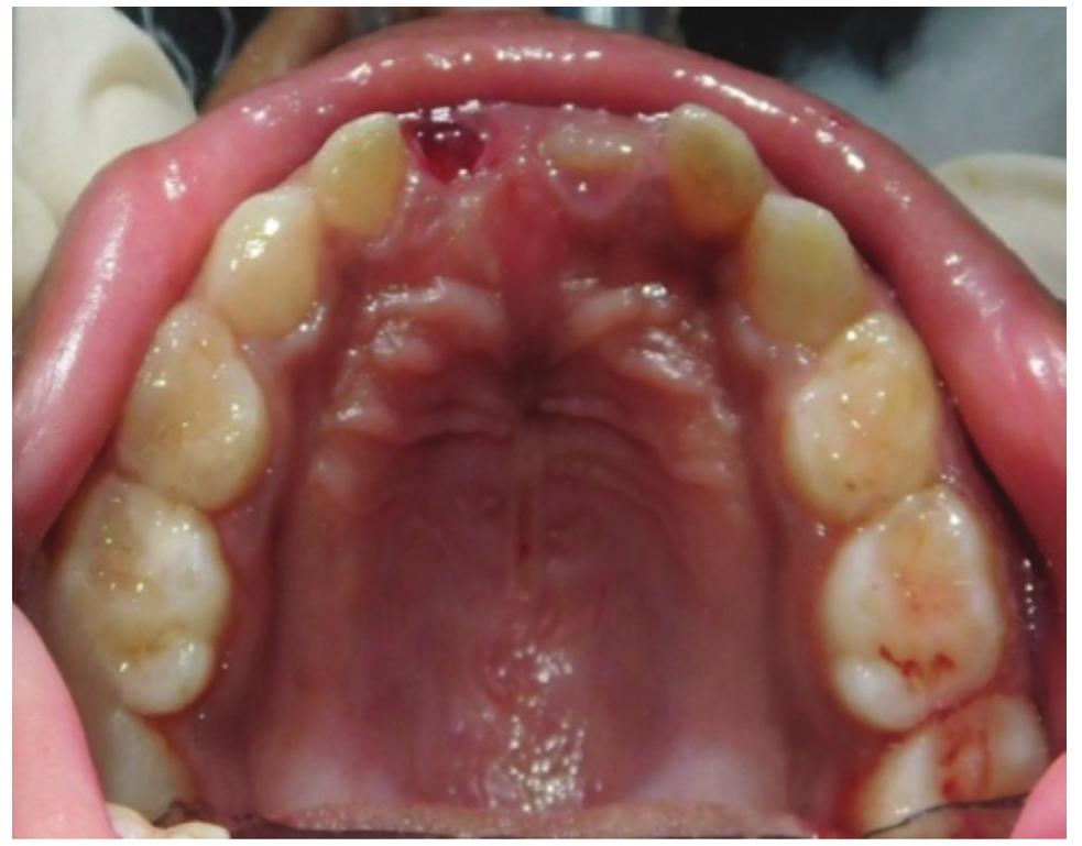 - postoperative view of maxillary arch