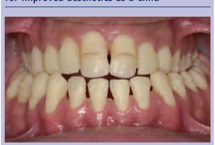 Anterior view in occlusion following the placement of