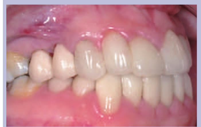 C right lateral view in occlusion. note the eruption of the