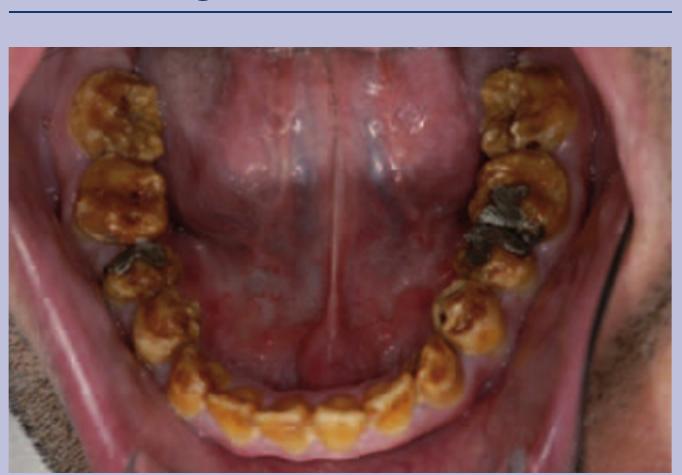 E pre-operative maxillary occlusal view. note the