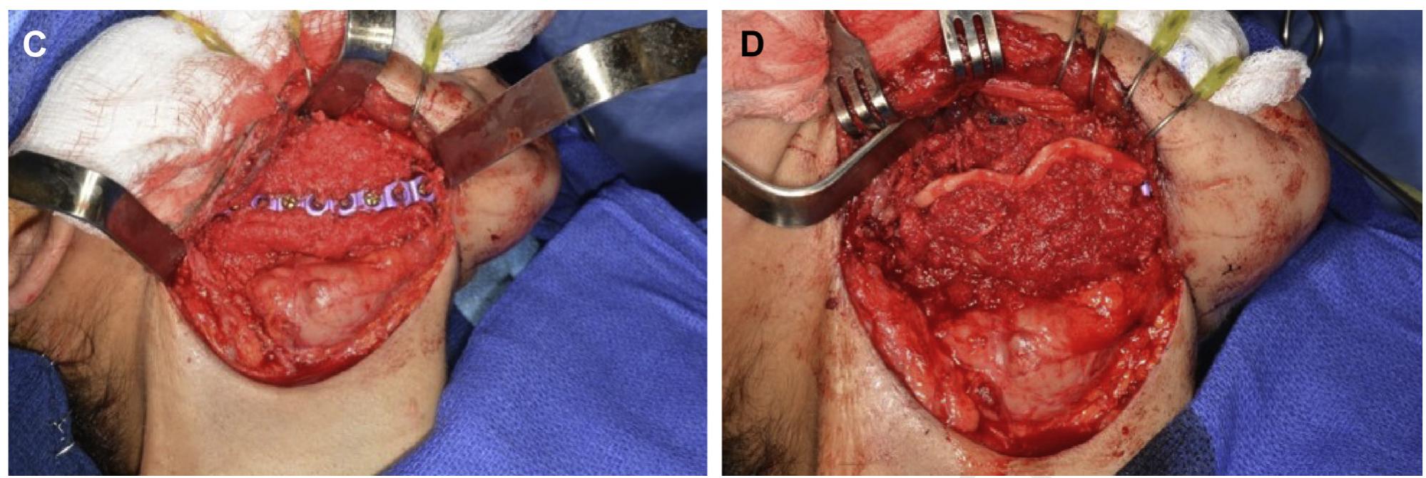 (cont’d). c, step 3: rigid fixation is provided and the