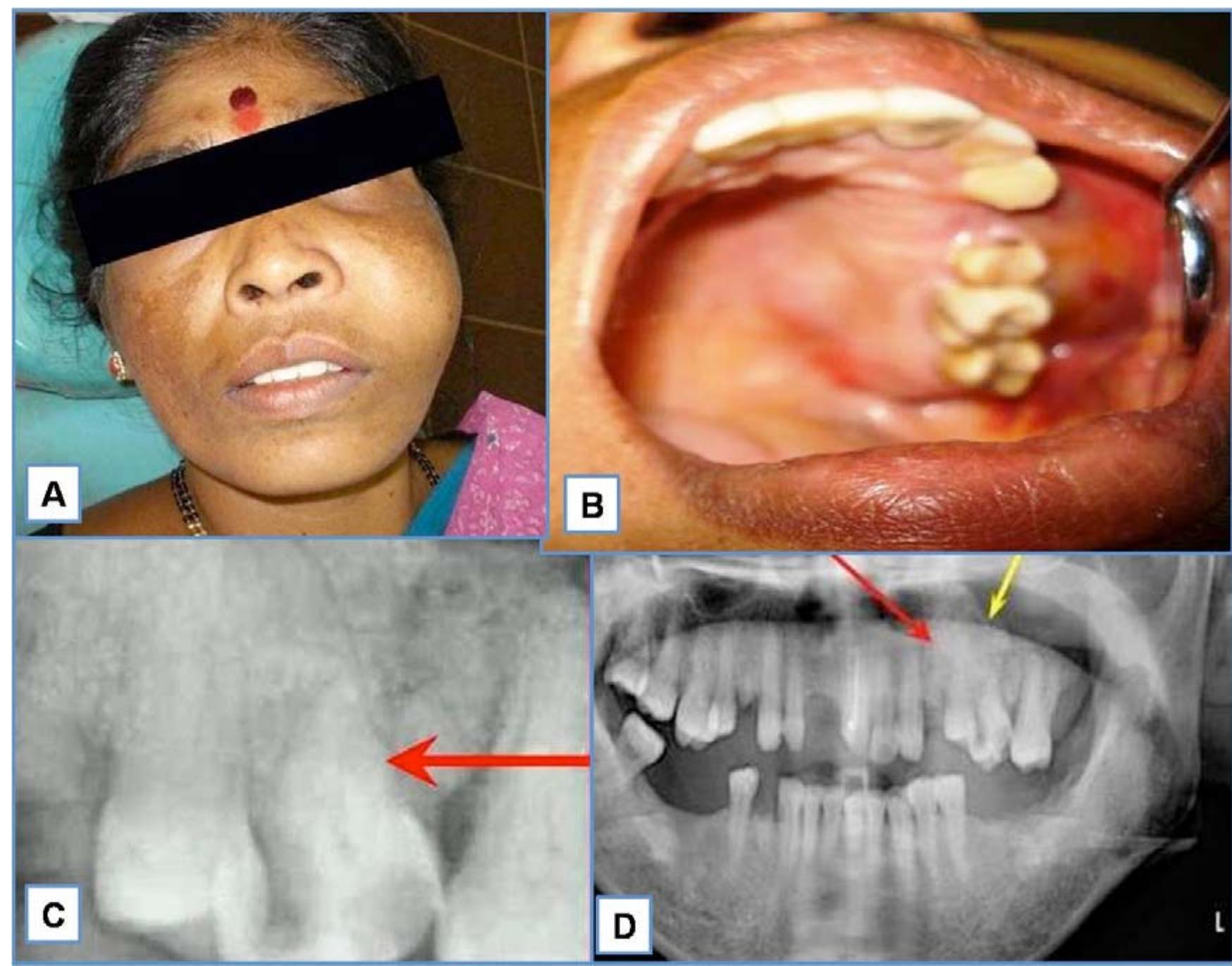 (1). a. extra oral swelling measuring 2x2 cms in the left