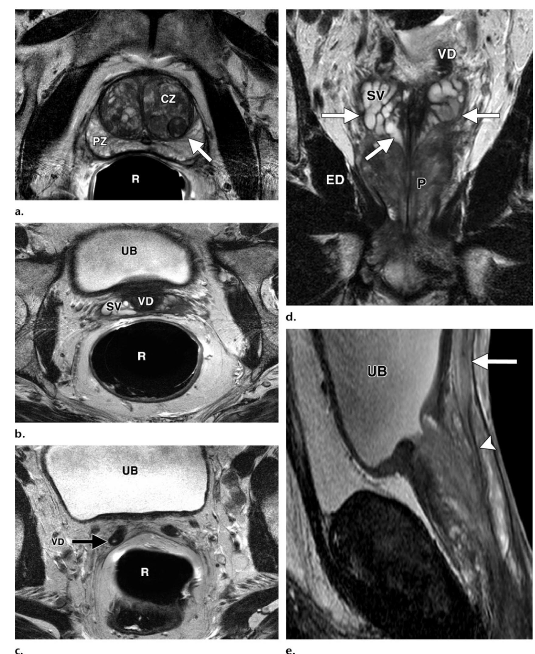 Anatomy of the prostate, seminal vesicles, and vas deferens