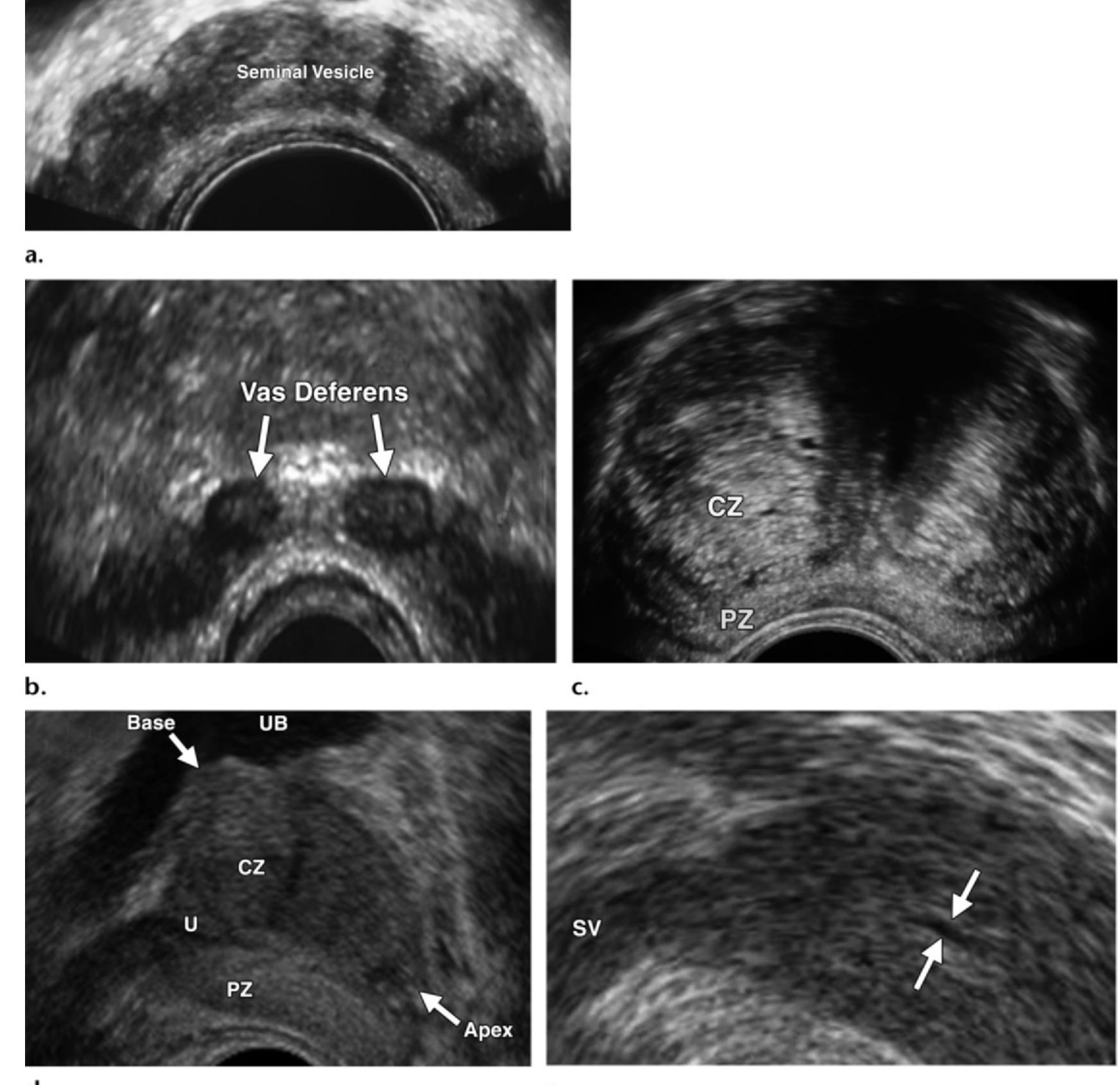 Figure 4 - from Cysts of the Lower Male Genitourinary Tract: