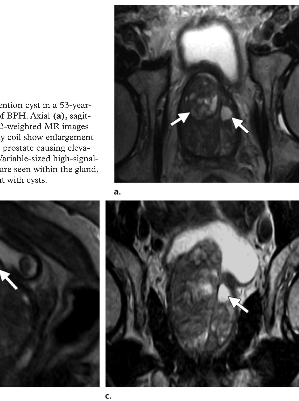 Figure 15 - Cysts of the Lower Male Genitourinary Tract: