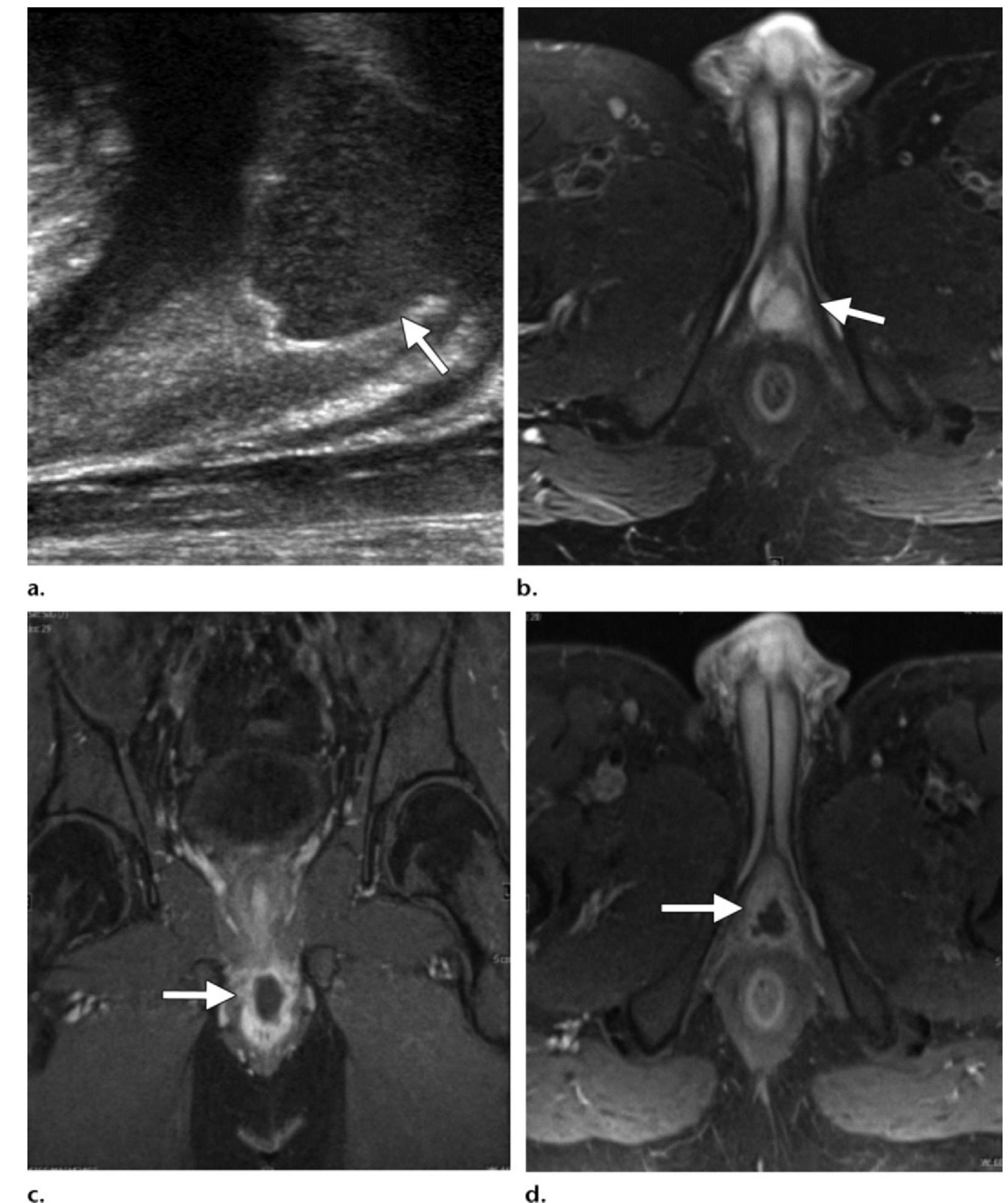 Cowper duct cysts. (a) sagittal 2d perineal us image shows a