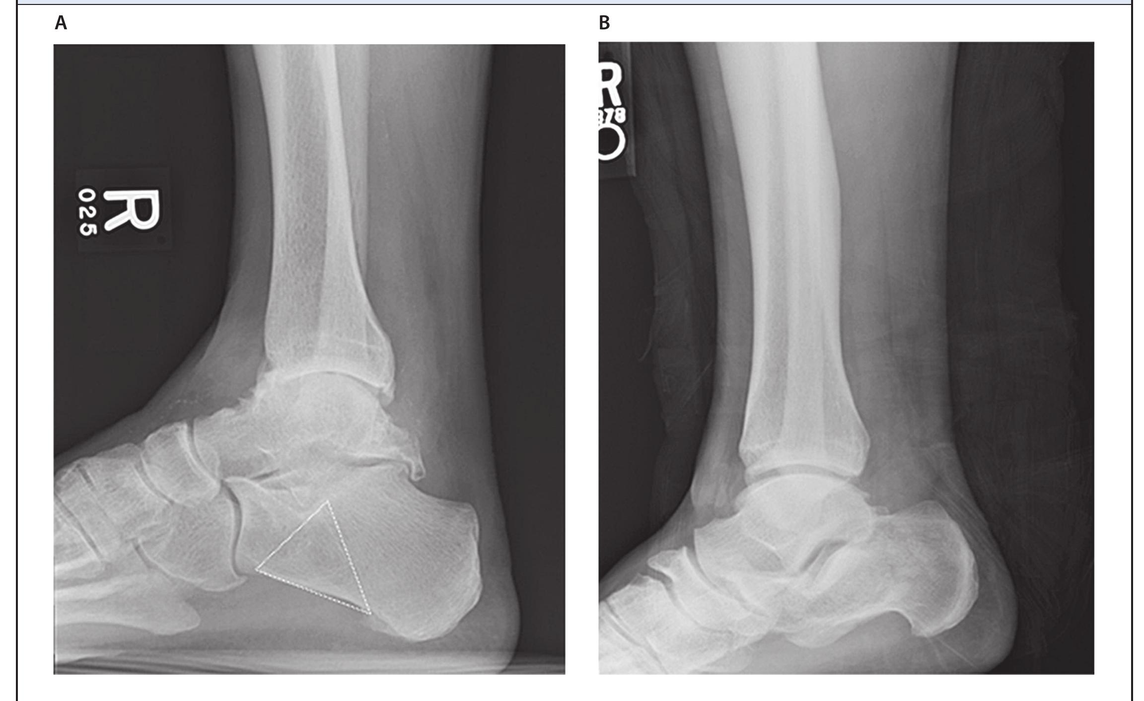 Jre 1 | axial loading is common mechanism for fractures of