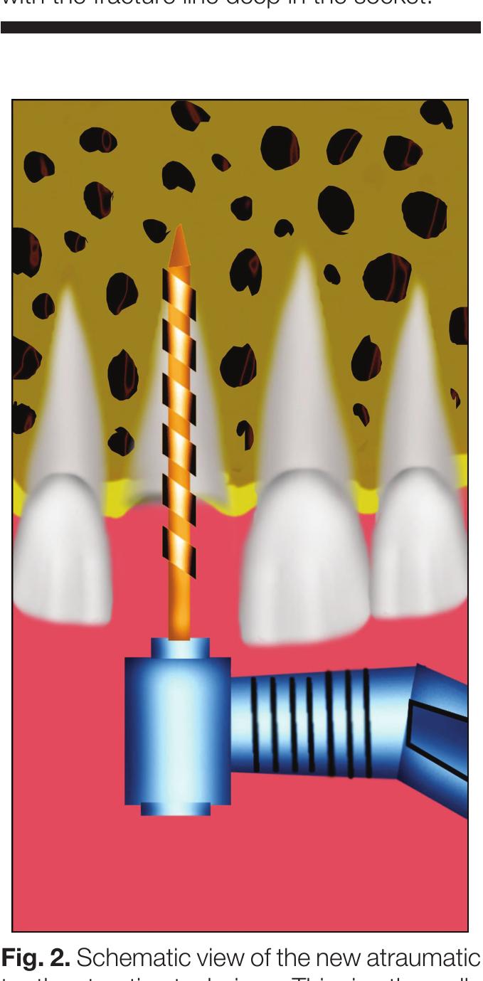 Figure 1 - A Technique for Atraumatic Extraction of Teeth